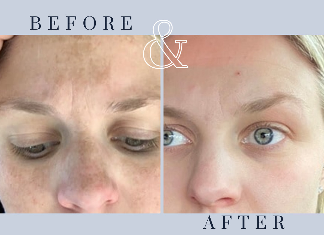 IPL "Intense Pulse Light" Non-ablative procedures | Services | Tailored ...