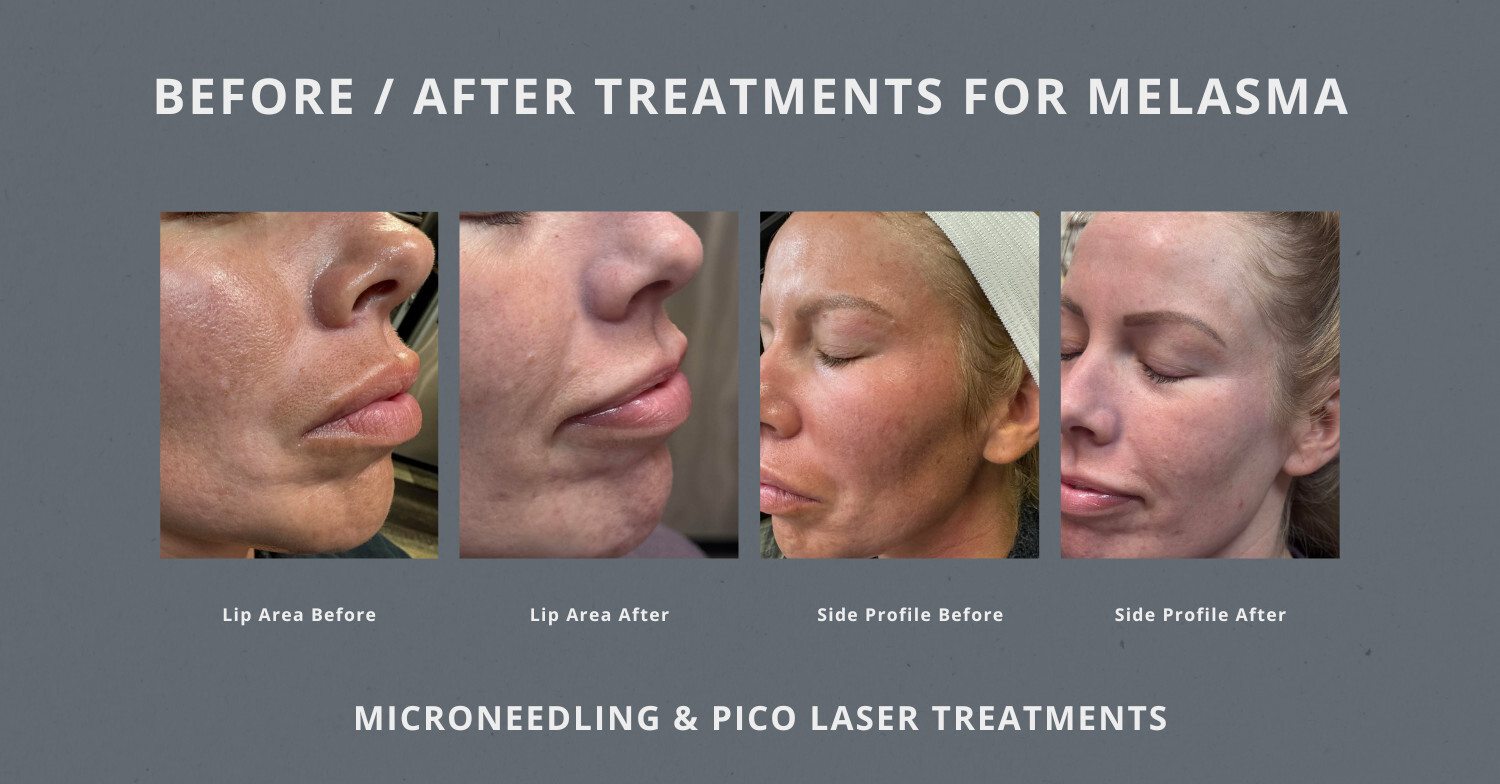 Understanding Melasma: Causes and Why a Personalized Plan Matters ...