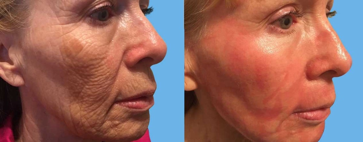 Phoenix CO2 Laser Face & Neck | Services | Tailored To You